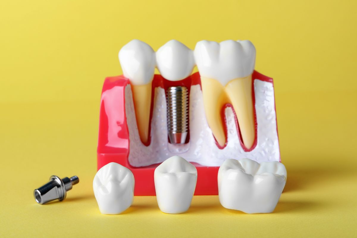 Dental Implants Without Bone Grafting – Best Alternatives Explained